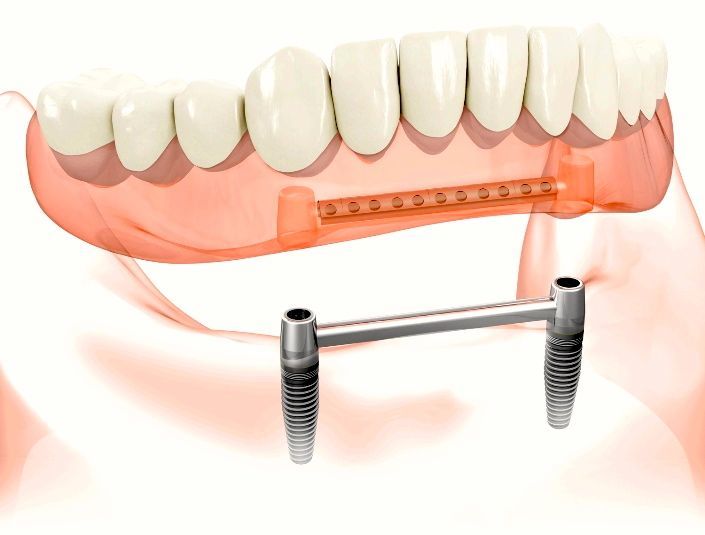 Klikgebit - Lowenthal Tandtechniek